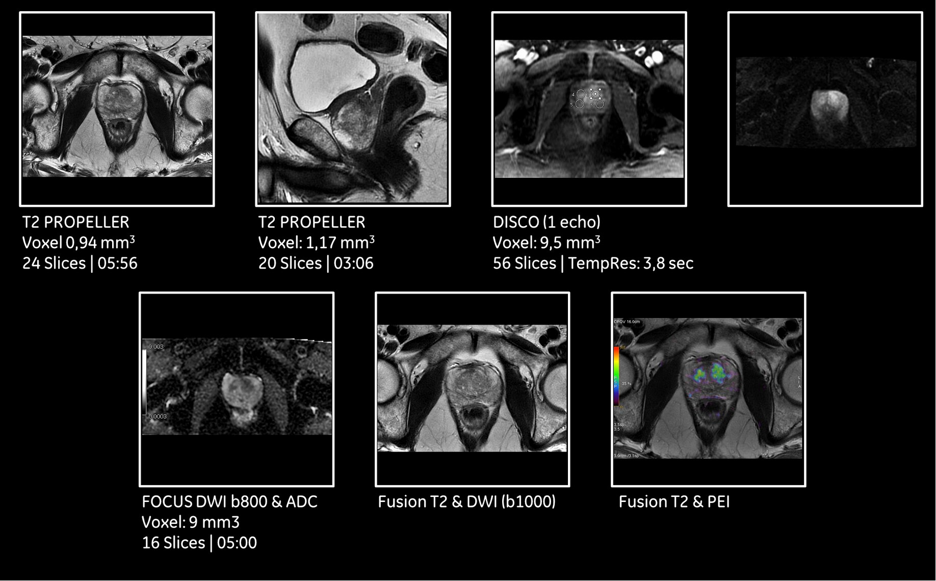 SIGNA™ Pioneer AIR™ Edition | GE HealthCare (France)